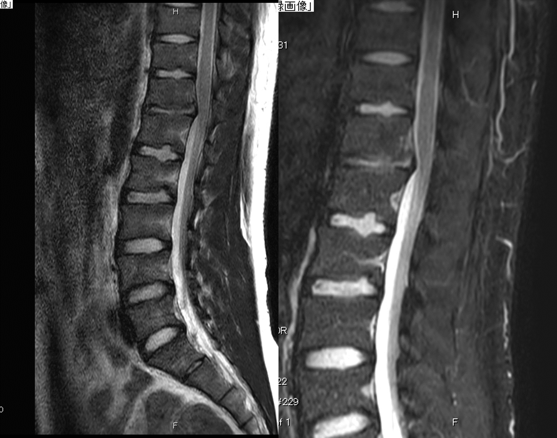 磁気共鳴医学会 〜脊髄病変で撮るシーケンス”PD-STIR”〜 | Radiation Journal｜医学部生や医療従事者のための画像診断 ...