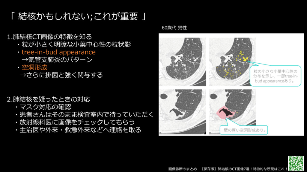 ウェブラジエーション勉強会 第4弾 ‐tree-in-bud sign‐ | Radiation Journal｜医学部生や医療従事者のための ...