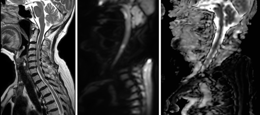 脊髄梗塞を撮る｜MRI画像の見方 | Radiation Journal｜医学部生や医療従事者のための画像診断、医療情報サイト