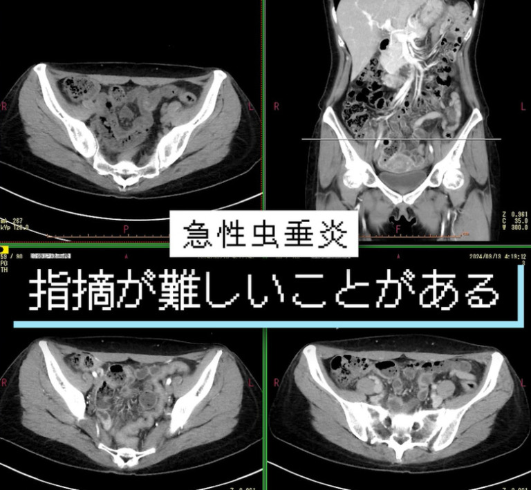 第9回ウェブラジエーション勉強会 ダイジェスト 第1弾 ―虫垂炎の画像診断― Radiation Journal｜医学部生や医療従事者の